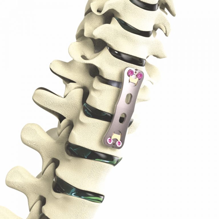 Apex Anterior Cervical Plate System - Orthopedic Inst