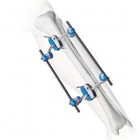 Bonofix Fixation System (Hoffman) - Orthopedic Inst