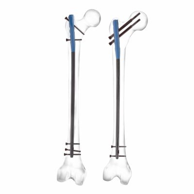 Expert Femoral Nailing System - Orthopedic Inst